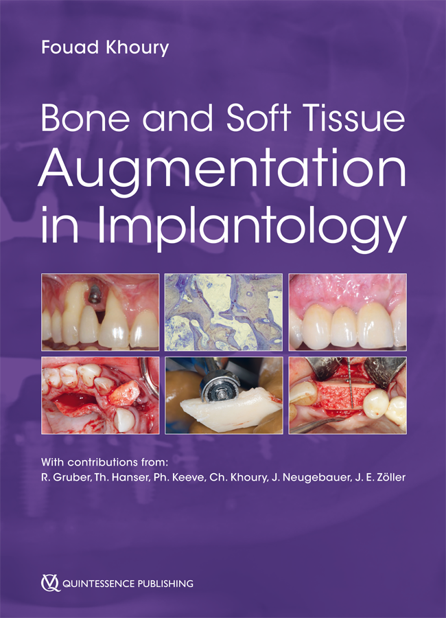 Bone and Soft Tissue Augmentation in Implantology - Derradji Dental Store